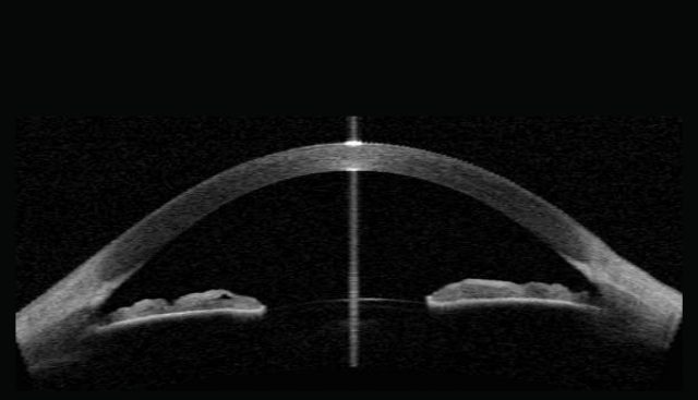 Anterior Segment Disorders - Solis Eye Care